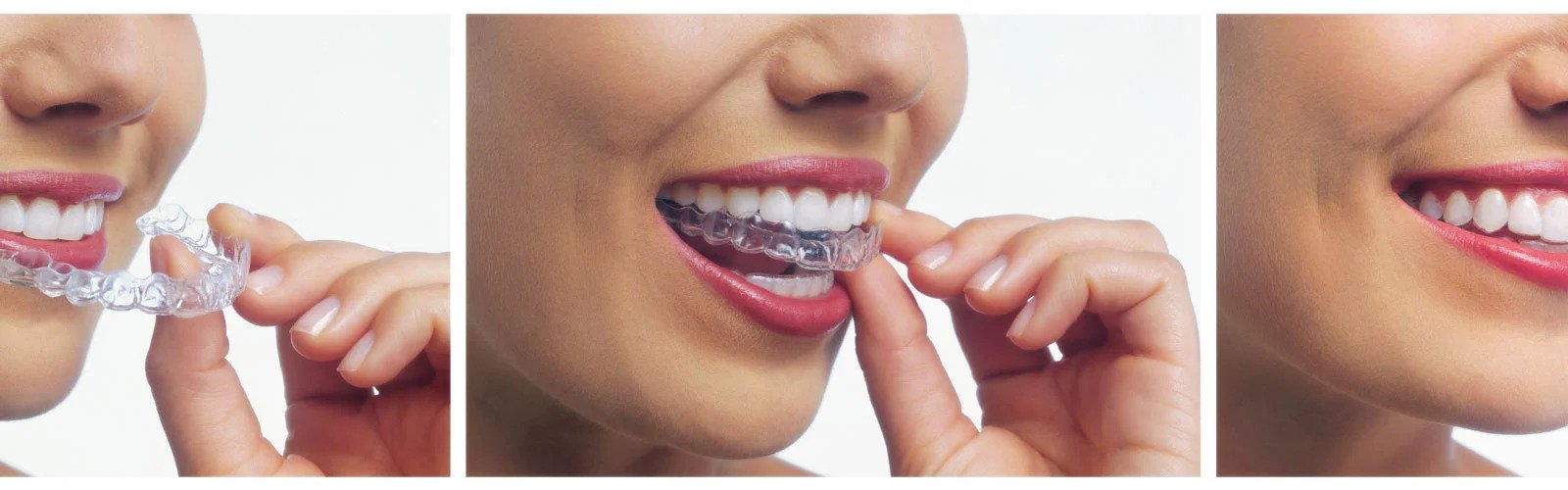 onzichtbare beugel invisilign Tandheelkundepraktijk Stadhouderskade ...